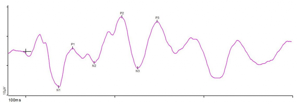 Visually Evoked Potentials (VEP) - Diagnosys LLC Visually Evoked Potentials (VEP) - Diagnosys LLC
