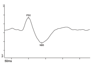 Exploring PERG: A Test for Macular Cone Function - Diagnosys LLC