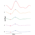 Multifocal Electroretinography (mfERG) - Diagnosys LLC