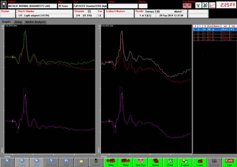 Full-field Electroretinography (ERG) - Diagnosys LLC