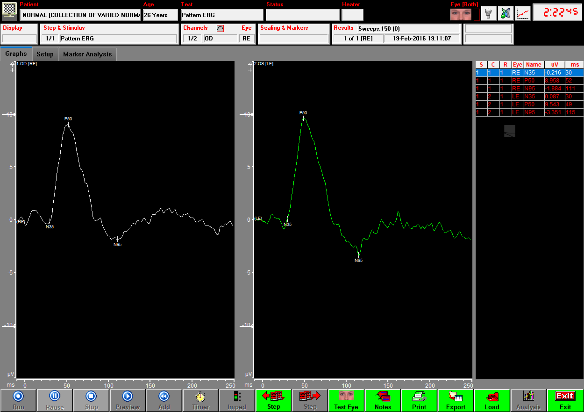 Exploring PERG: A Test for Macular Cone Function - Diagnosys LLC