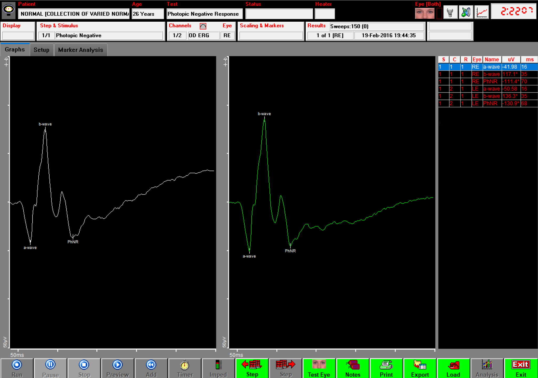 Photopic Negative Response (PhNR) - Diagnosys LLC