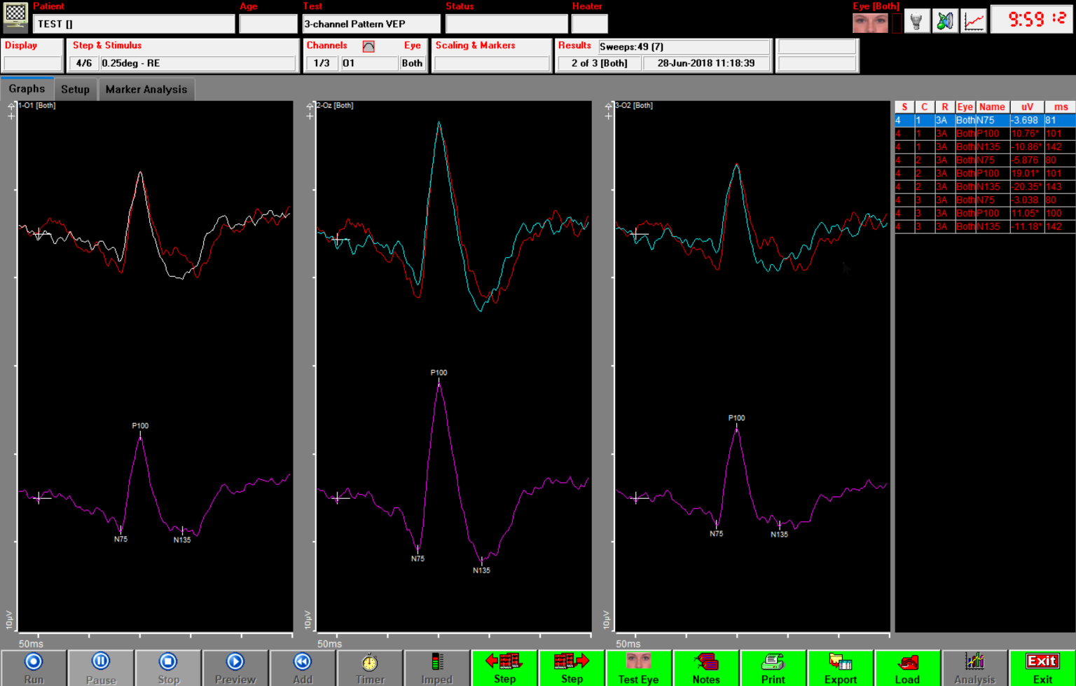 Visually Evoked Potentials (VEP) - Diagnosys LLC Visually Evoked Potentials (VEP) - Diagnosys LLC