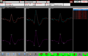 Visually Evoked Potentials (VEP) - Diagnosys LLC