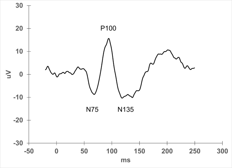 Visually Evoked Potentials (VEP) - Diagnosys LLC